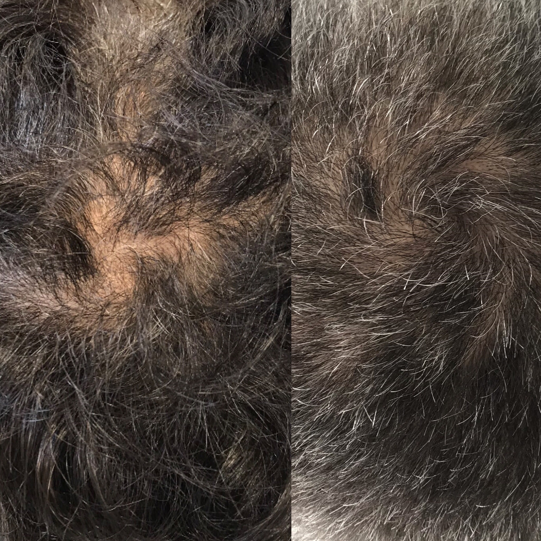 PRP Growth Factors for Hair Loss - Platelet Rich Plasma Regrowth